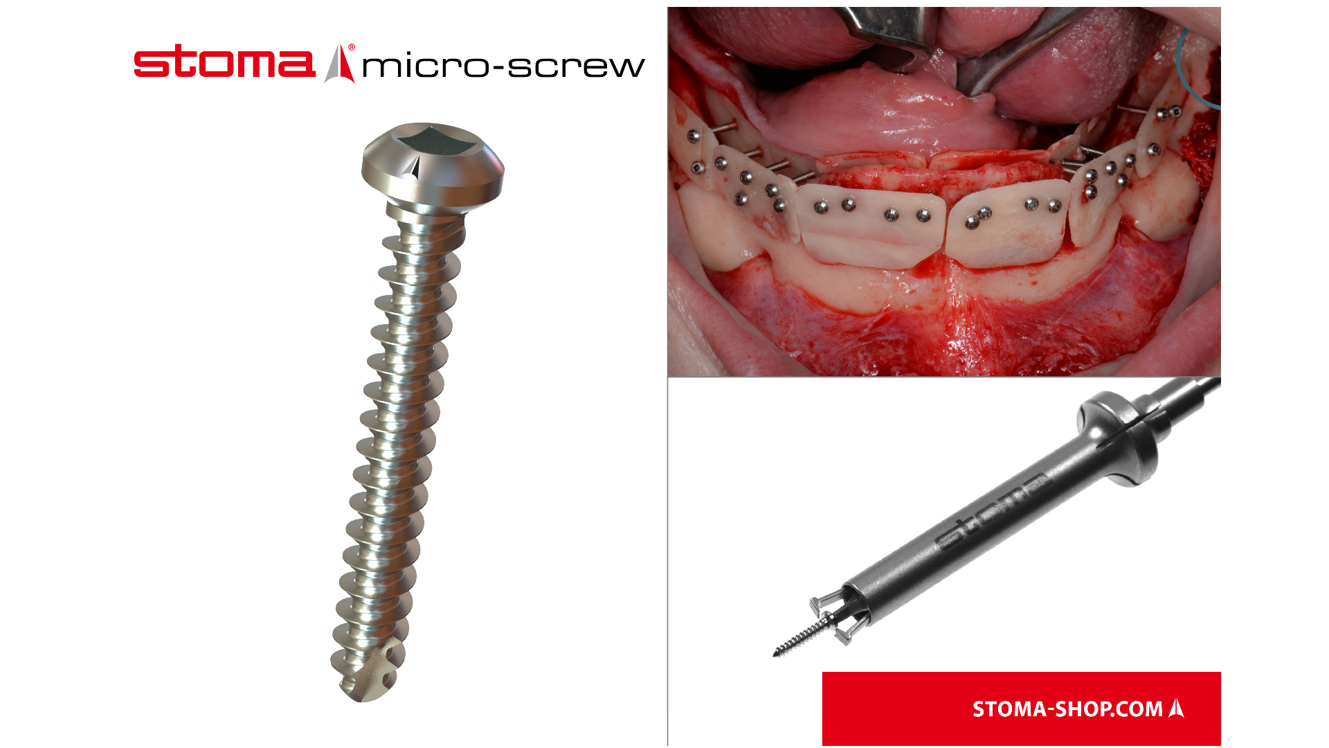 stoma® micro-screw – Dentex